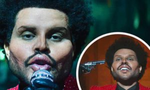 Bandages are off: The Weeknd’s plastic surgery look shocks fans