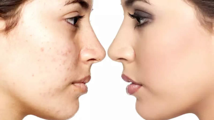 8 Tips to Get Rid of Blemishes