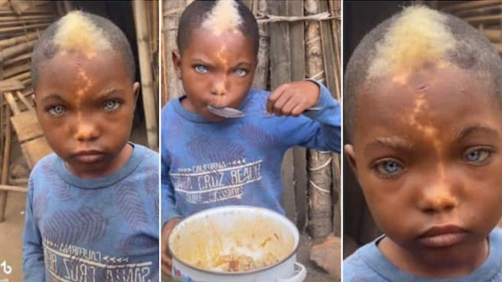 Video of Little Boy with Lightning Marks on His Face, White Frontal ...