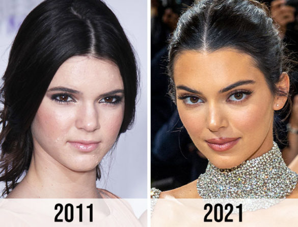 Kendall Jenner Denies Having Plastic Surgery But These Before And After 7953